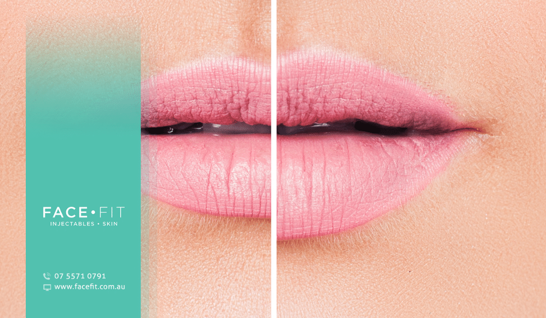 Lip Injections Before and After - Face Fit