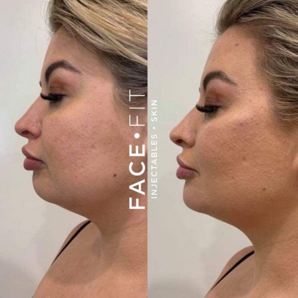#1 Skin Treatments and Injectables Clinic Gold Coast | Face Fit